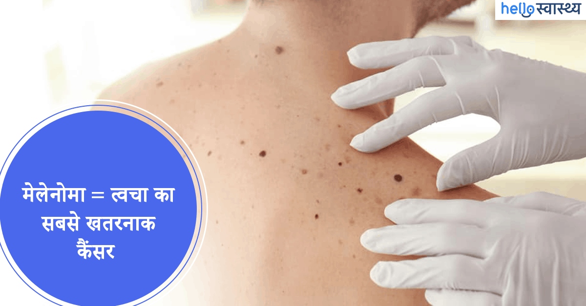 Melanoma (Skin Cancer) - मेलेनोमा (त्वचा का कैंसर) क्या है? जानें इसके ...