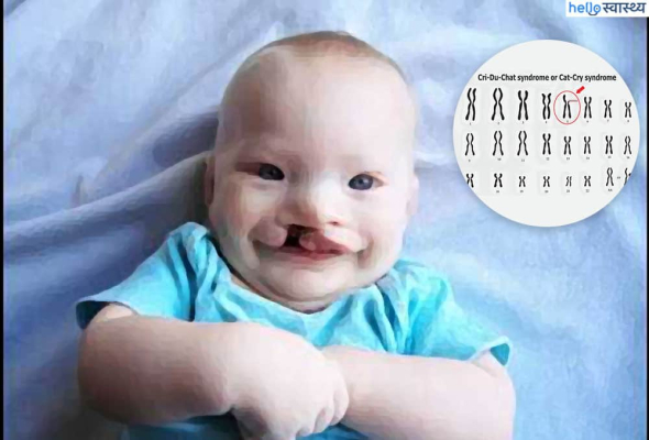Cri du chat syndrome : क्री दू शात सिंड्रोम क्या है? | हैलो स्वास्थ्य