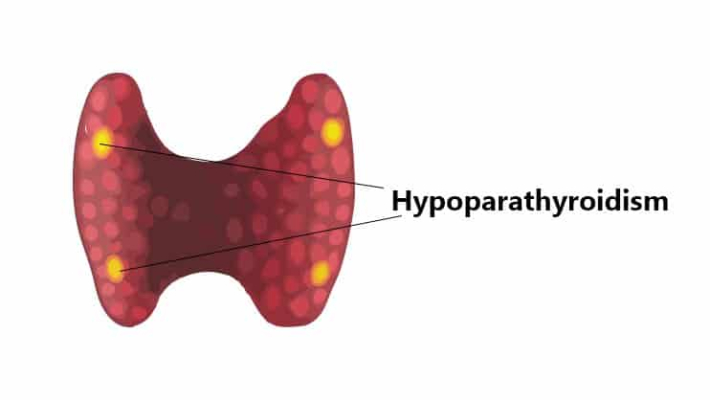 Hypoparathyroidism : हायपोपैराथायराॅइडिज्म क्या है? - हैलो स्वास्थ्य