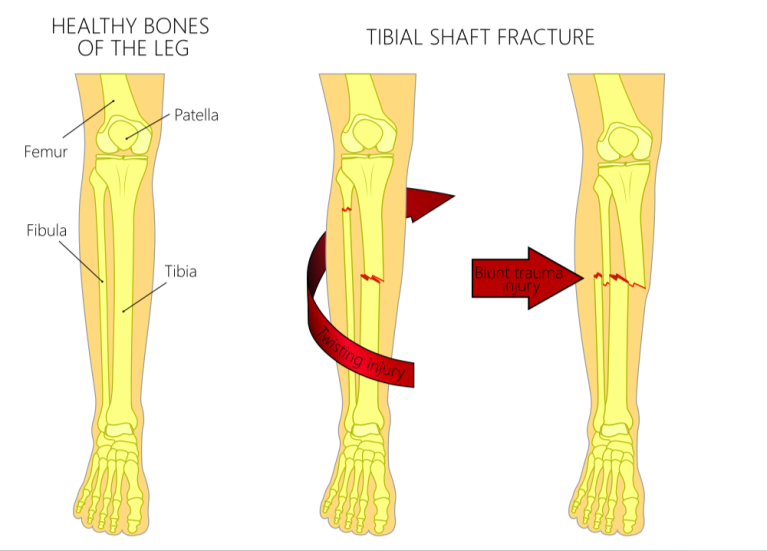 Broken (fracture) lower leg : ब्रोकन लोअर लेग क्या है? - हैलो स्वास्थ्य