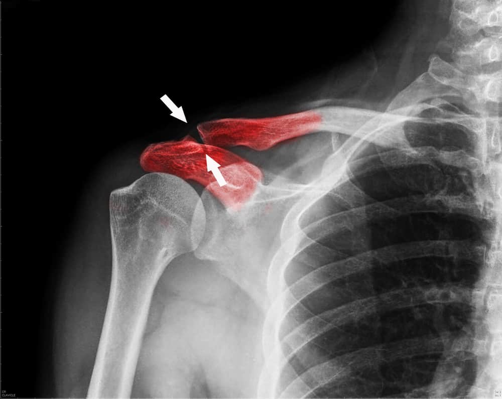 Broken Collarbone (Clavicle): कॉलरबोन टूटना क्या है? जानें इसके कारण ...