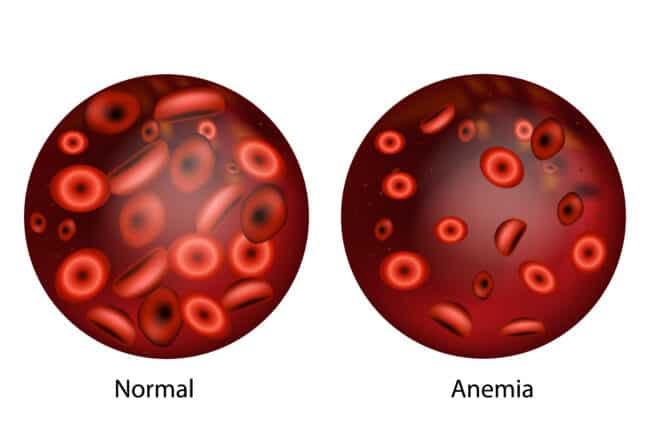 नॉरमोसाइटिक एनीमिया (Normocytic Anemia) क्या है? - हैलो स्वास्थ्य